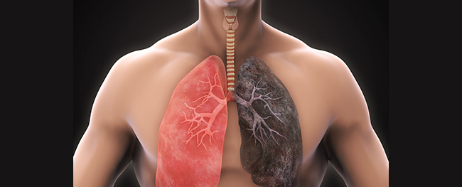 Diferencias entre bronquitis y bronquiolitis